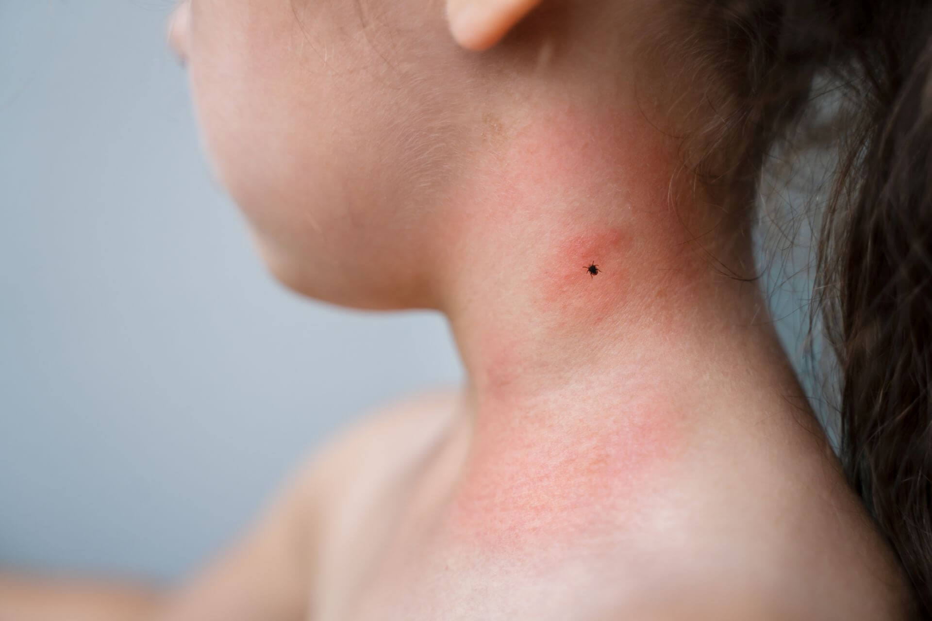 Borreliose Bei Kindern